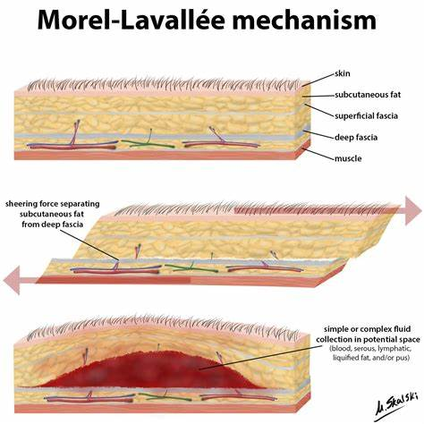 Morel-Lavallée Lesions – Pass with PASS, LLC