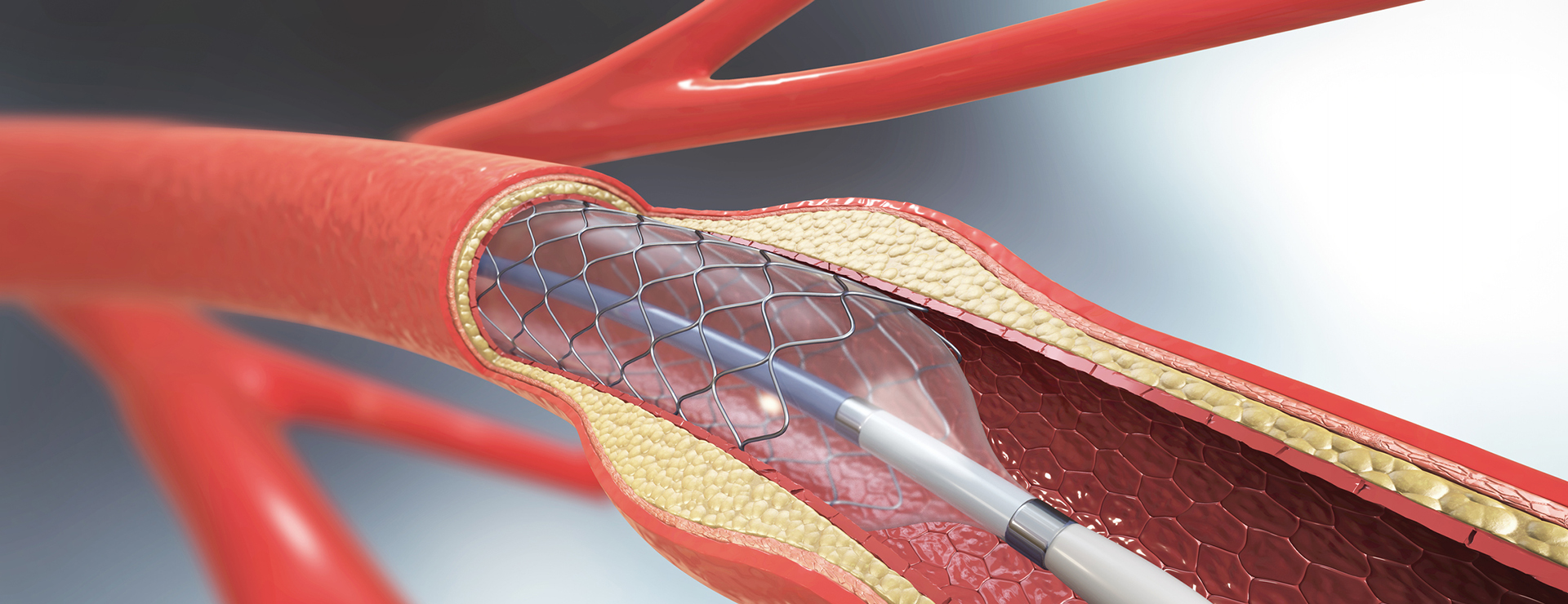 Coronary Stenting: Flow Restoration – Pass with PASS, LLC